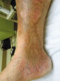 Skin Changes & Venous Stasis Ulcers | Locastro Vein Center